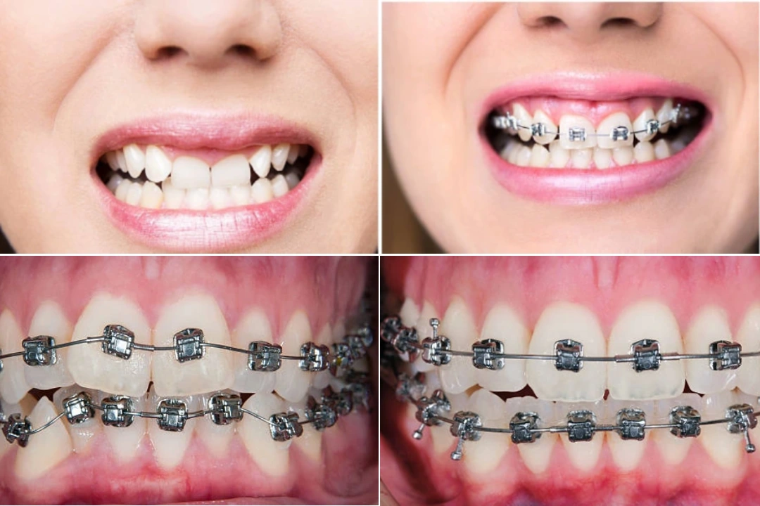 Before and After: How do Braces Change the Shape of Your Face? Before and After: How do Braces Change the Shape of Your Face?